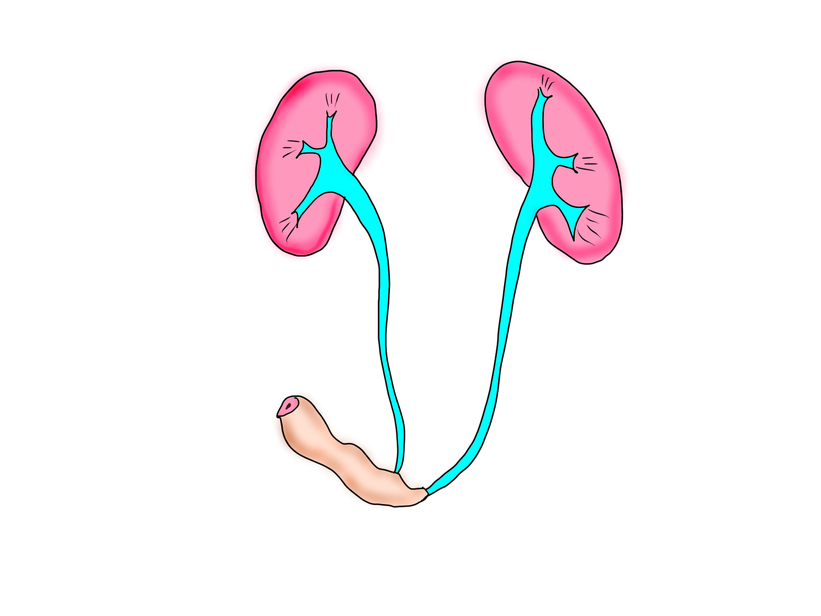 Relieving Ureteral Stricture After Ileal Conduit Surgery