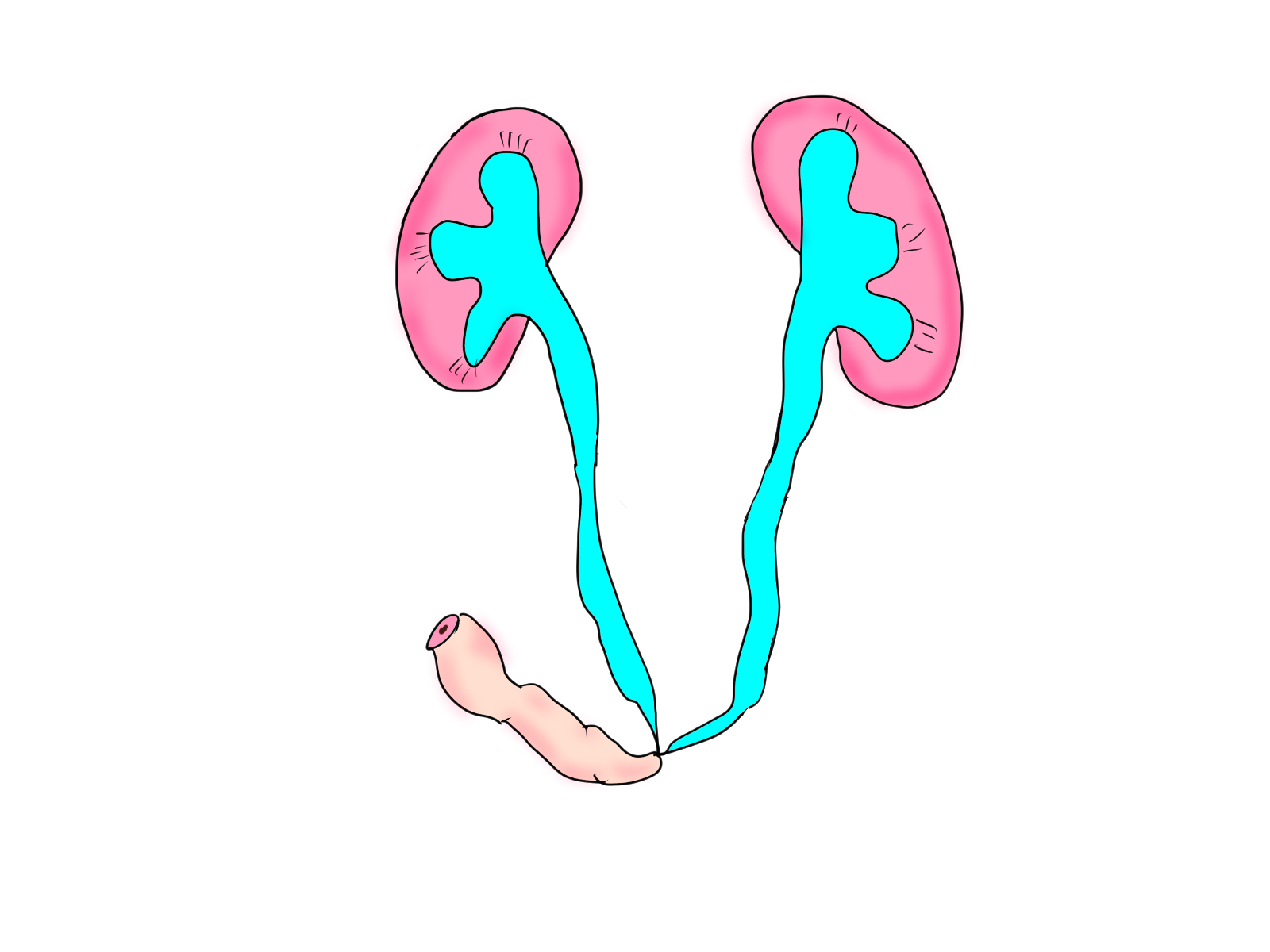 Relieving Ureteral Stricture After Ileal Conduit Surgery